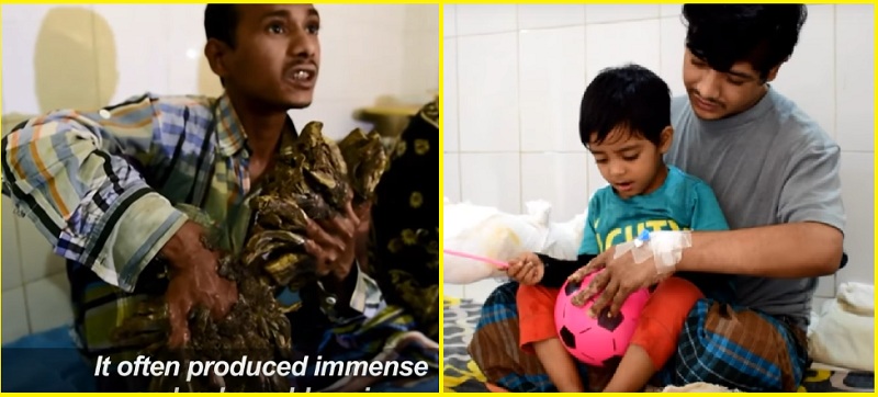 Bangladeshi 'Tree Man' Gets Hope After Multiple Operations