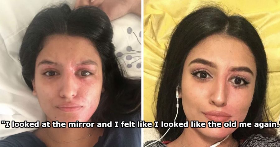 Aspiring Model Reveals How She 'Recovered' Her Looks After Suffering ...