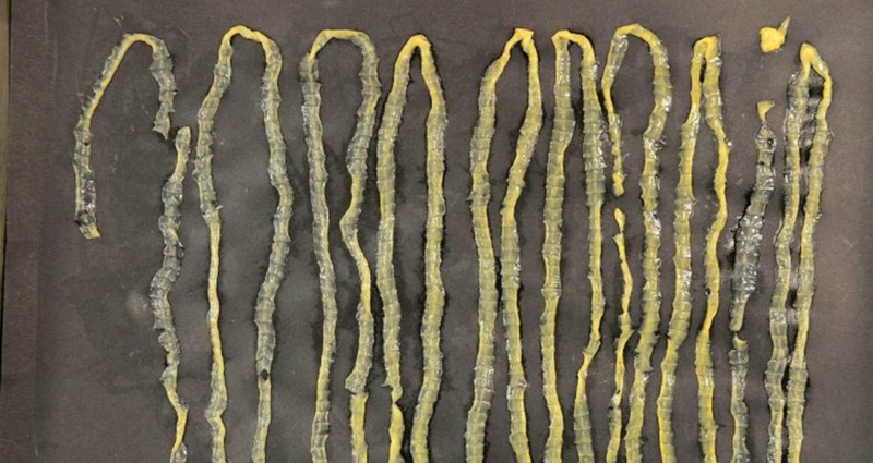 Doctors Extract 9-Foot Tapeworm From Singaporean Man's Rectum