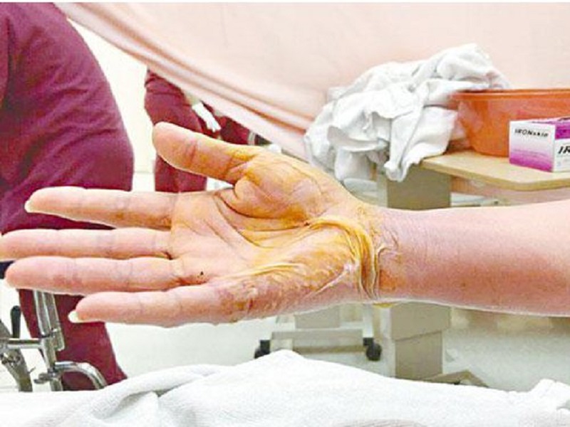 31 Actors Suffer Terrible Burns After Movie Stunt Goes Wrong in ...