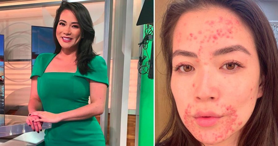 Frances Wang: CBS Reporter Reveals Skin Condition on Instagram