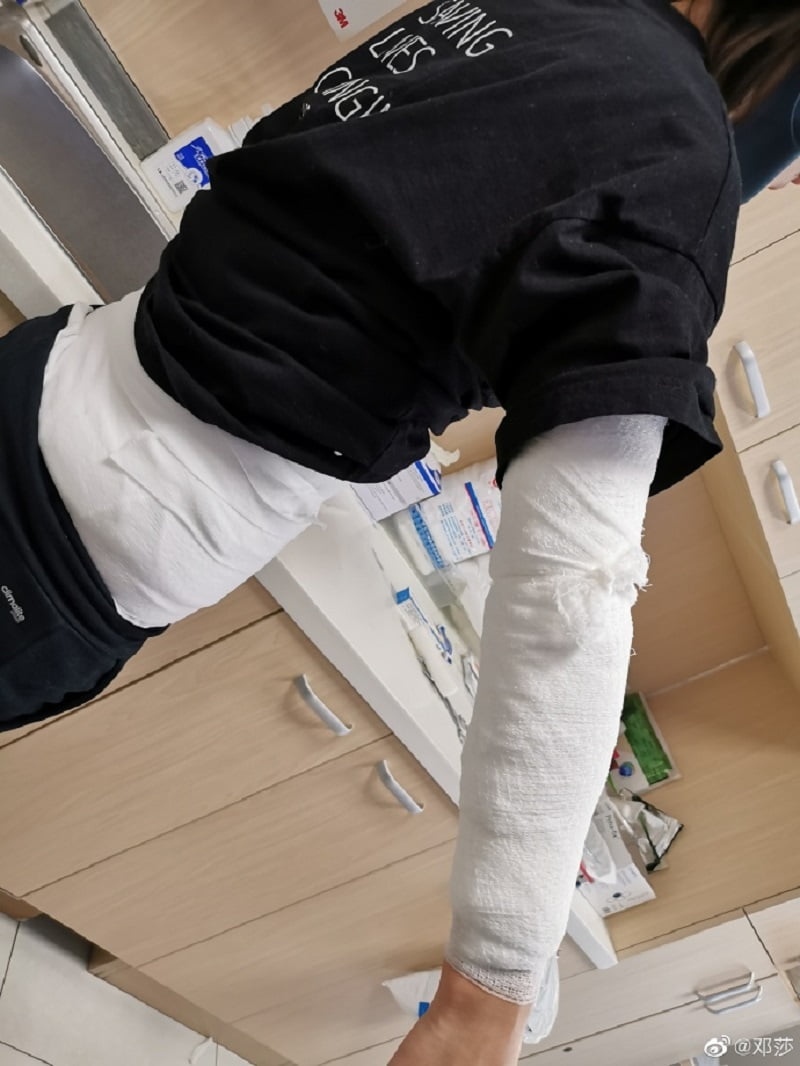 Chinese Actress Suffers Severe Burns From Fire Cupping Therapy ...