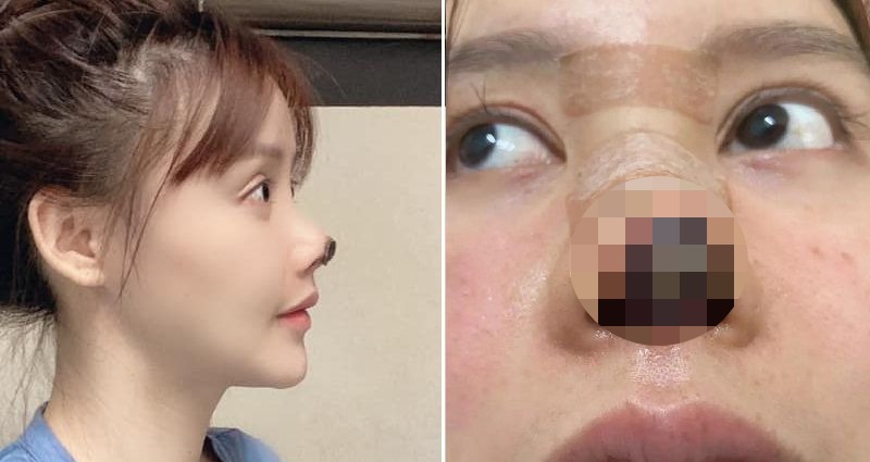 Chinese Actress Reveals ‘Rotting’ Nose from Cosmetic Surgery That Put ...